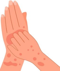 Can Kratom Cause a Skin Rash?